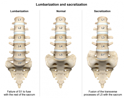 Μεταβατικός σπόνδυλος - Ιεροποίηση του Ο5 Κ. Κωσταβάρας Νευροχειρουργός ...